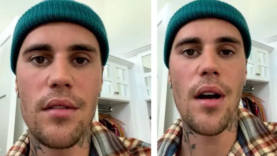 Justin Bieber's half facial paralysis due to rare disorder Ramsay Hunt ...